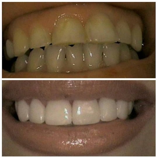 Photo: Before and After Opening the Bite and Using Veneers to Restore ...