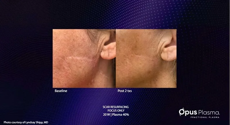Before and after earlobe rejuvenation — smoother skin after 3 Opus ...